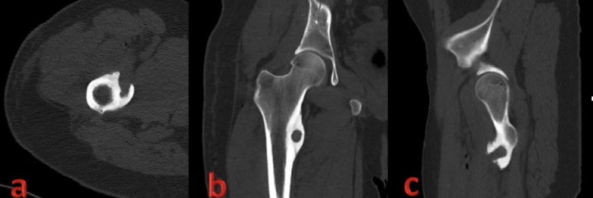 Kas-İskelet Sistemi Tümörleri Hakkında Genel Bilgiler | Dr.Osman Civan