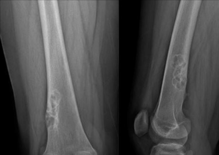 Non Ossifying Fibroma | Dr.Osman Civan